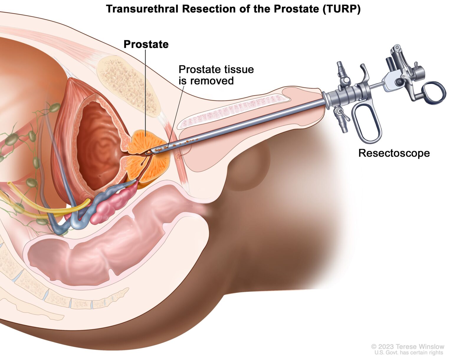 Transurethral Resection Of The Prostate (TURP) - Malvi Hospital